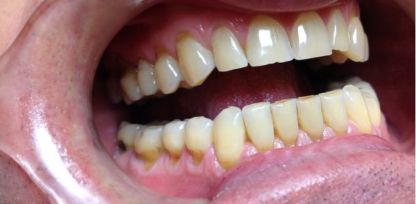 Tooth Abrasion: Causes, Signs and Prevention. | Beyond Smile 247
